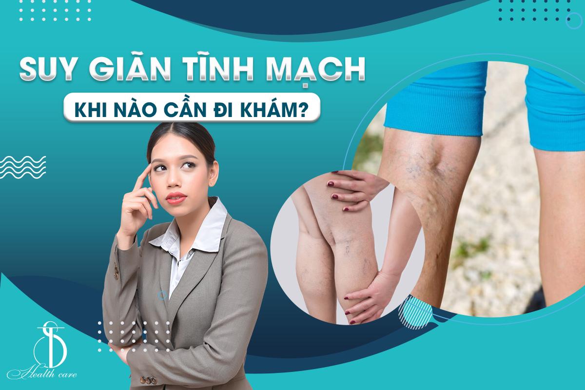 Suy giãn tĩnh mạch Khi nào cần đi khám?